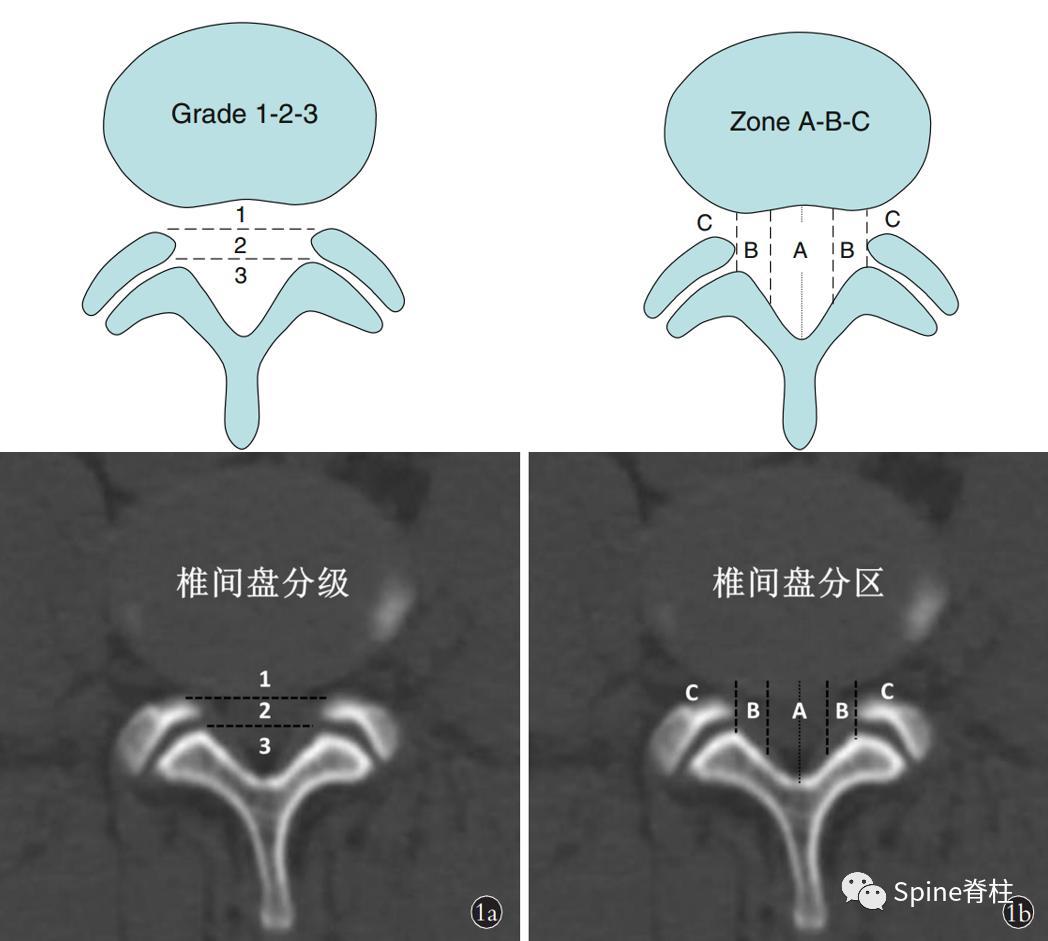 MSU grading and division of lumbar disc herniation (commonly used ...