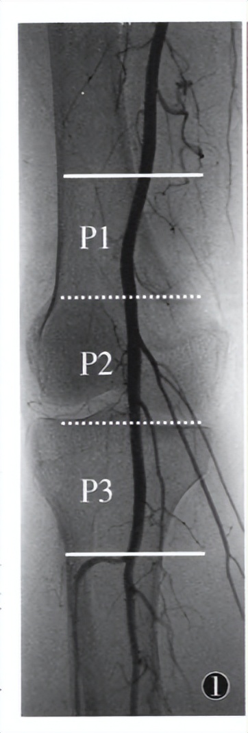 Intervention Literature Issue 7 (Peripheral Interventions) - DEB vs ...