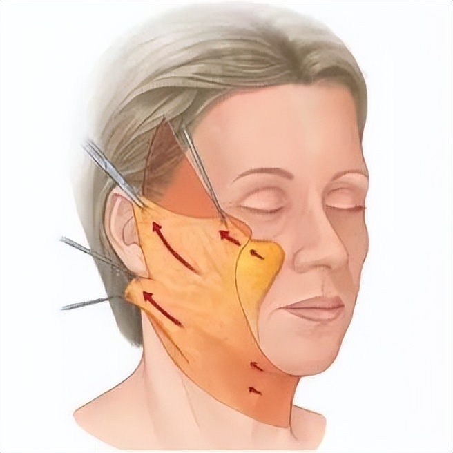 Why is the expression unnatural after facial line sculpting? - iNEWS