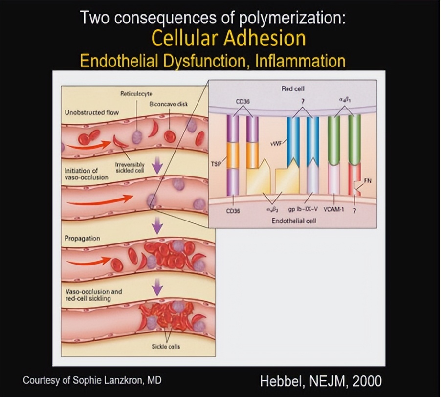 Sickle cell retinopathy: progress and breakthroughs - iNEWS