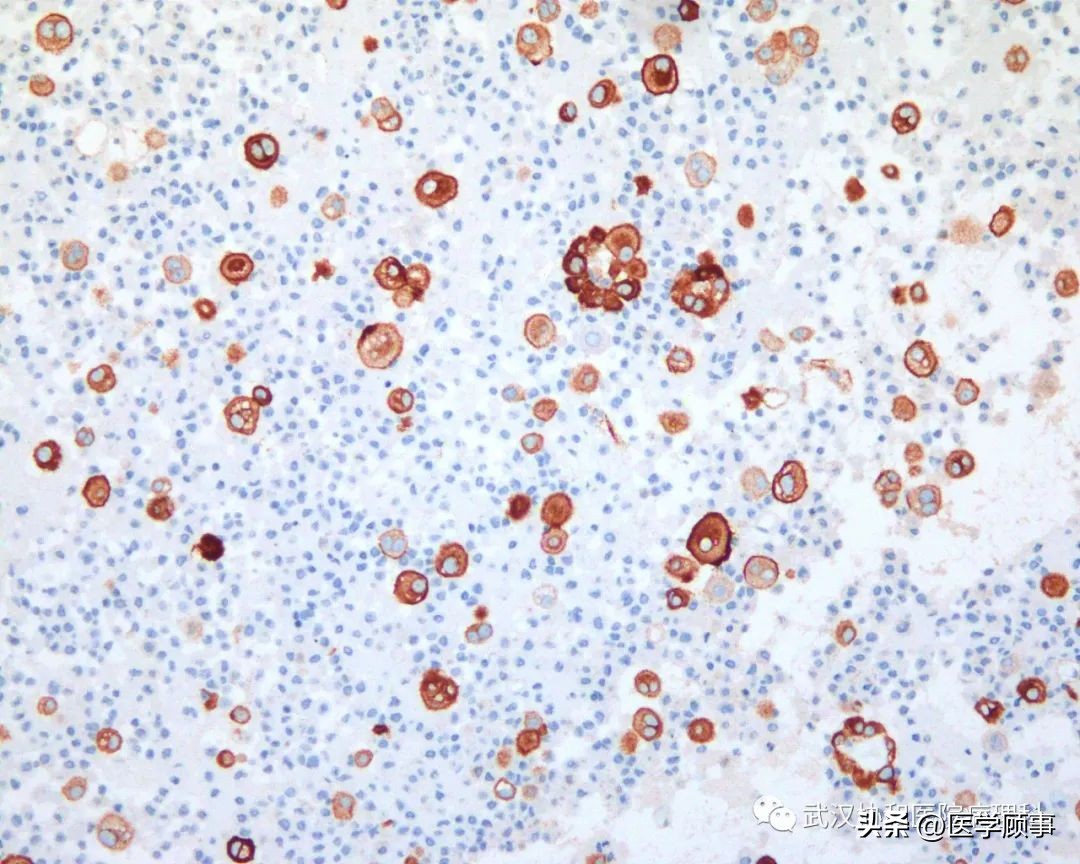 Cytopathological serous cavity effusion cytology specimen - iNEWS