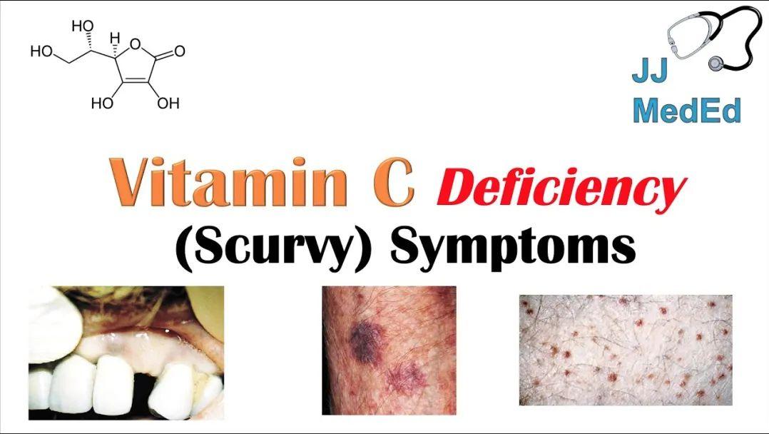 Will I get scurvy if I stop eating a lot of vitamin C? - iNEWS