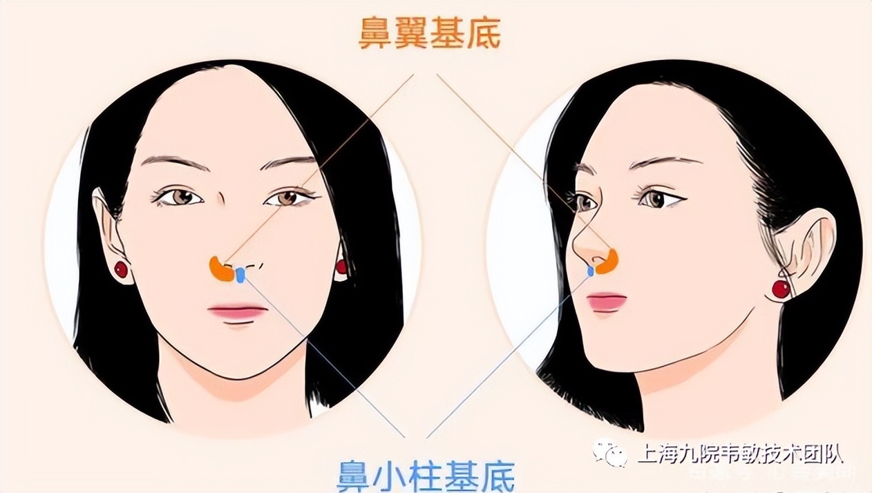 Do you understand the elongation of the nasal columella? - iNEWS