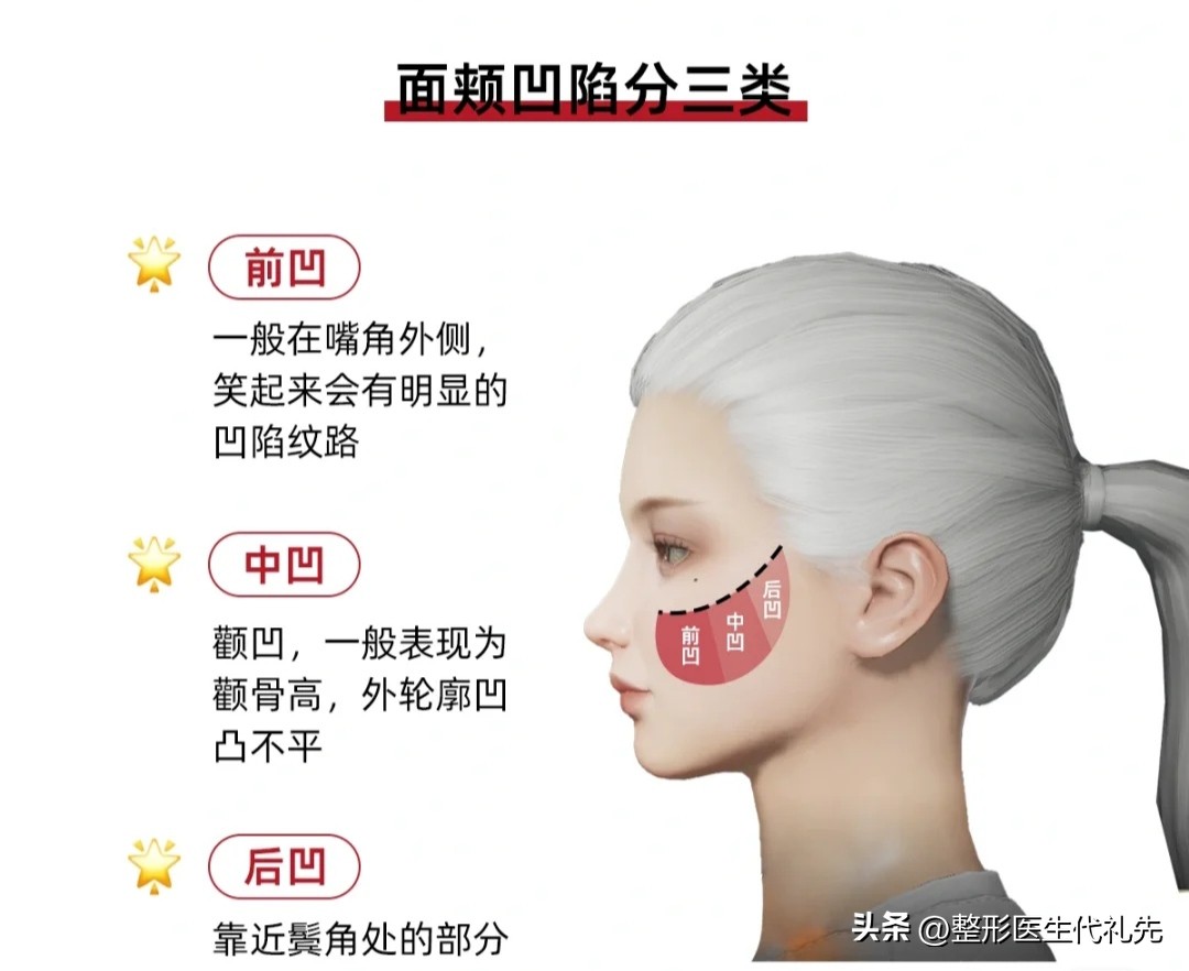 The sunken cheeks are too old, how should I fill them to avoid sagging ...