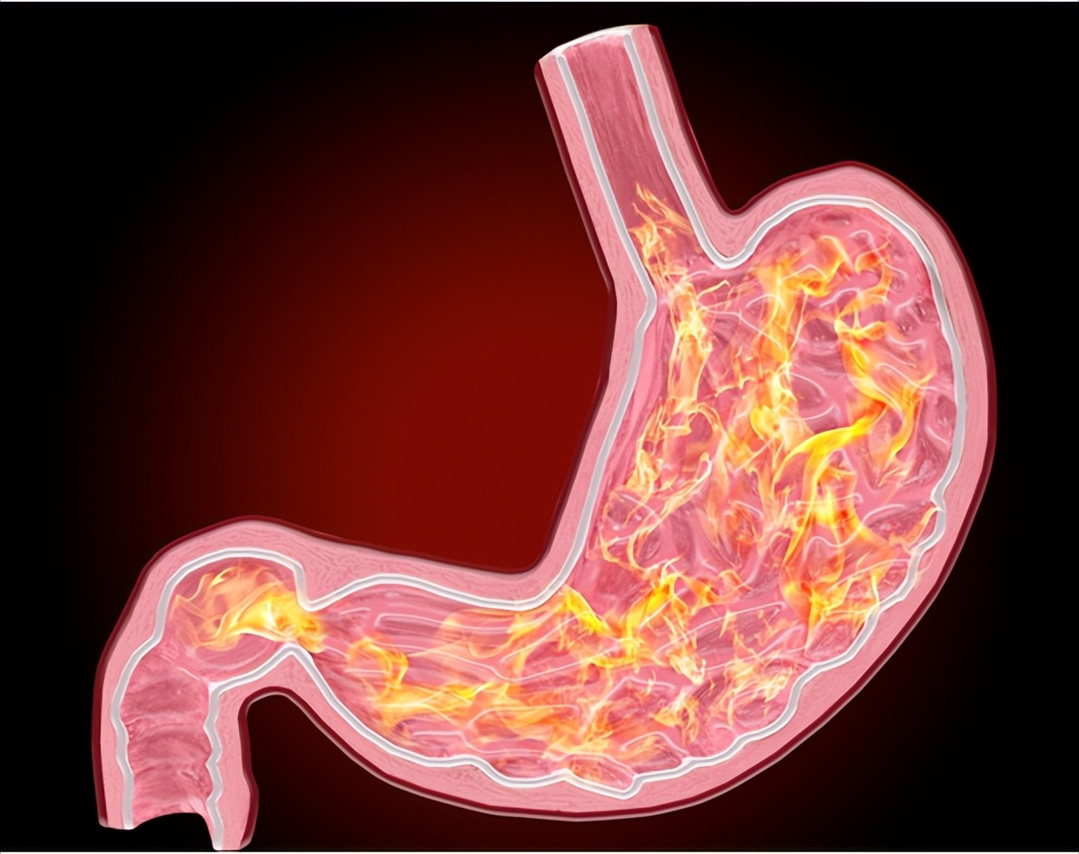 Know the gastric mucosal protectant: aluminum magnesium carbonate - iNEWS