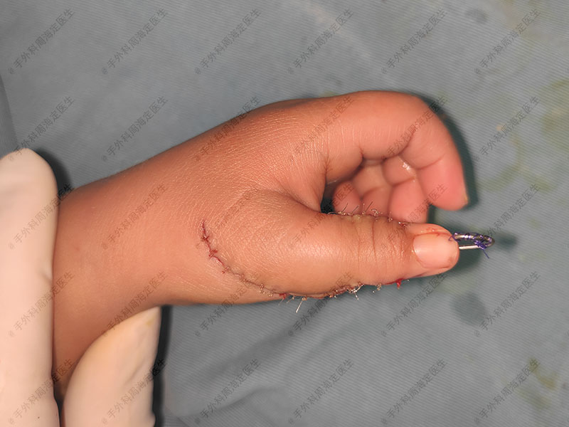 Although the child's crab claw polydactyly is complicated, the ...