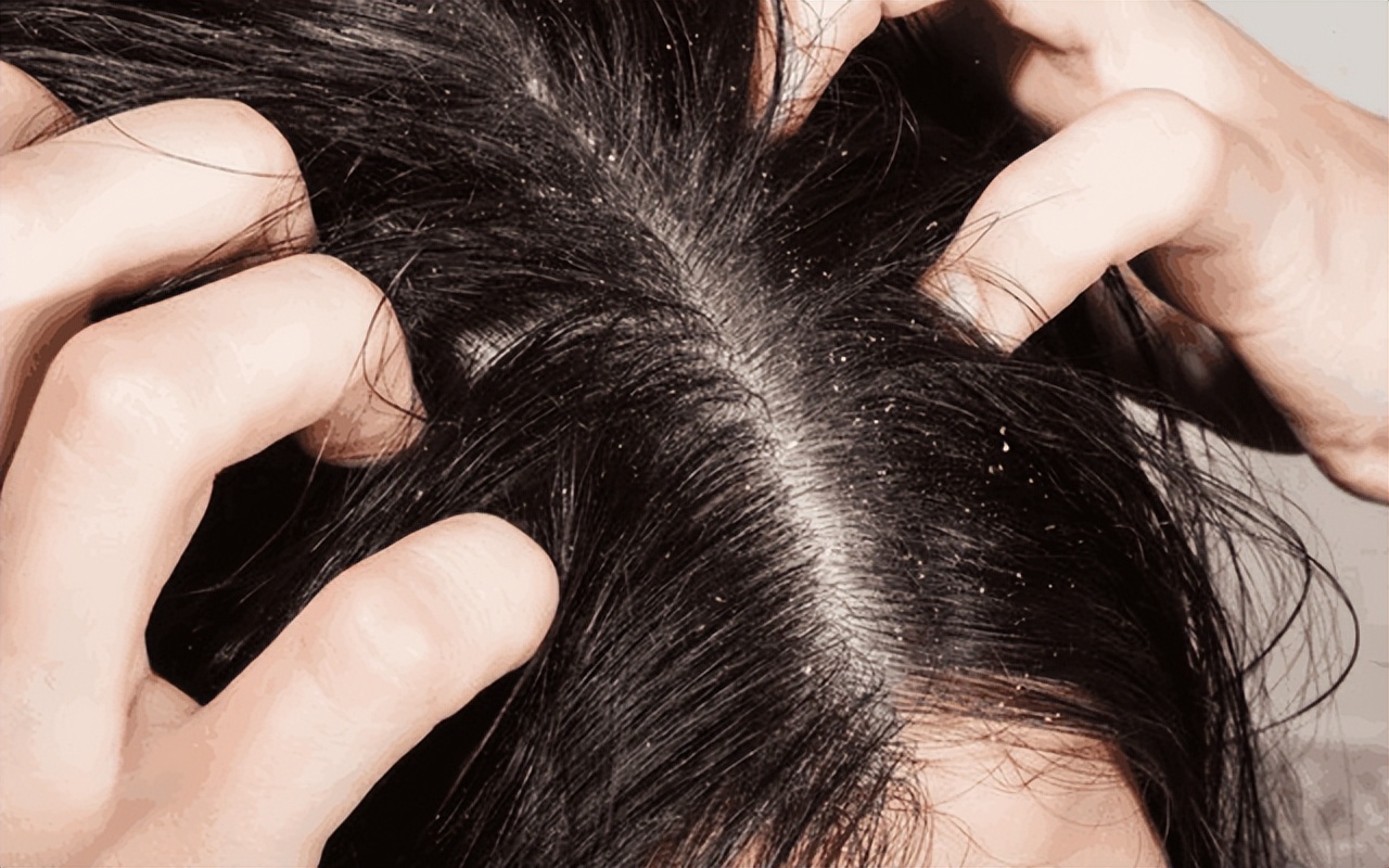Pustules and pimples often grow on the scalp, what's the matter?Doctor ...