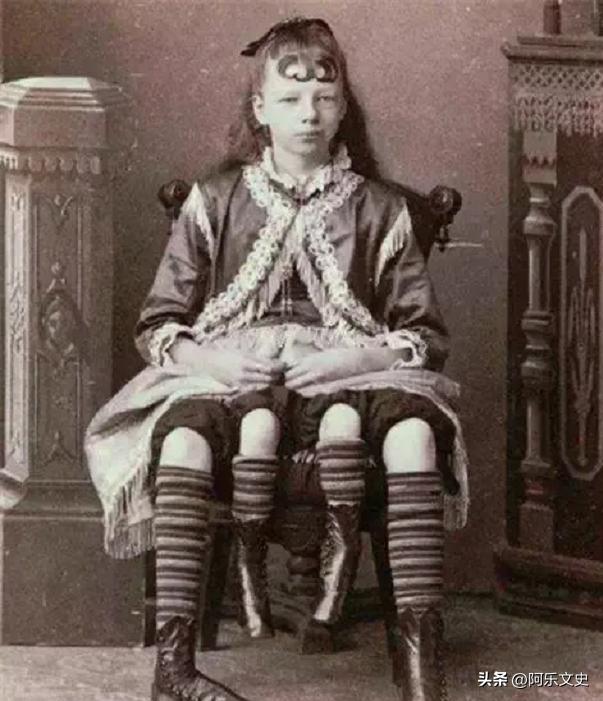 The lucky deformed child in the United States was born with 4 legs, has ...