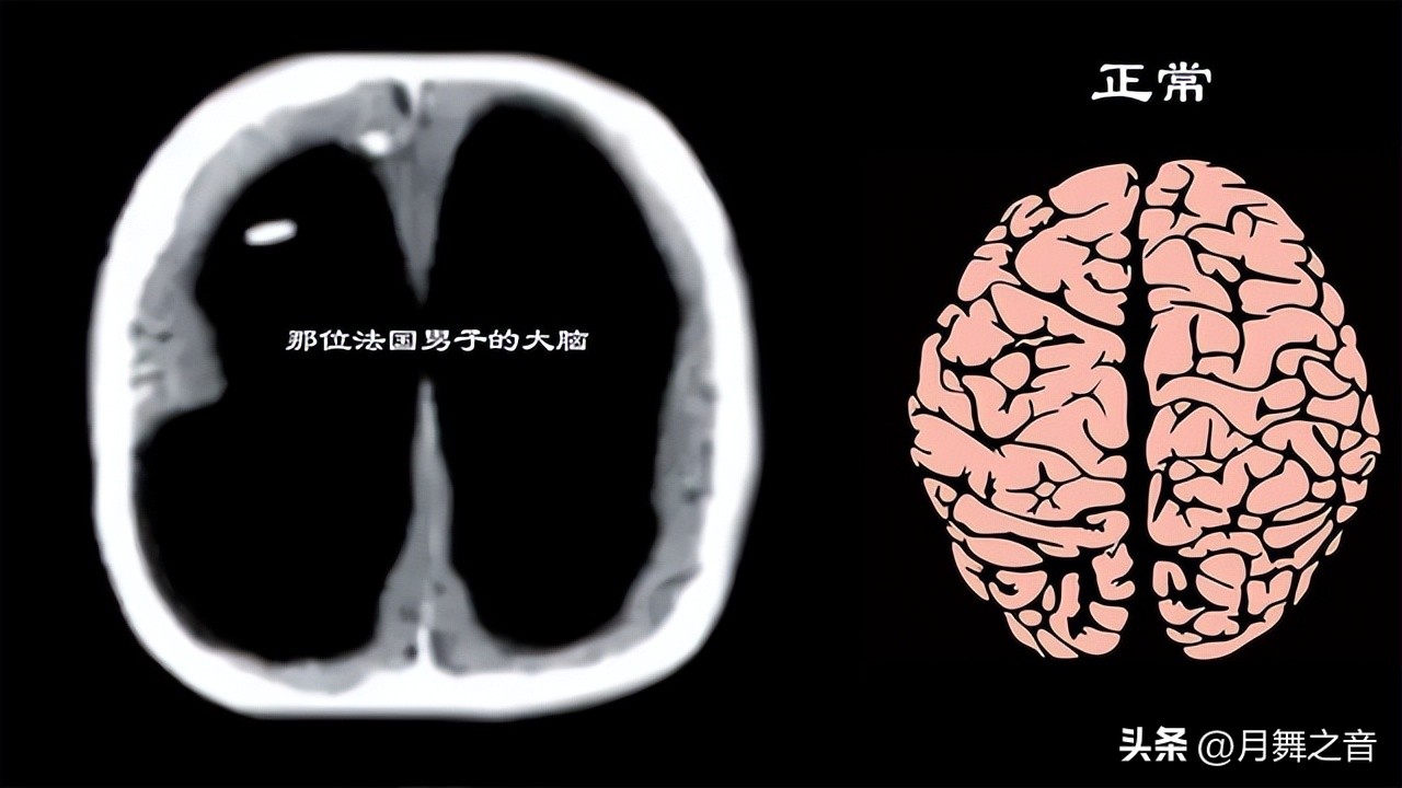 Can humans survive without their brains?Scientists discover 'brainless ...