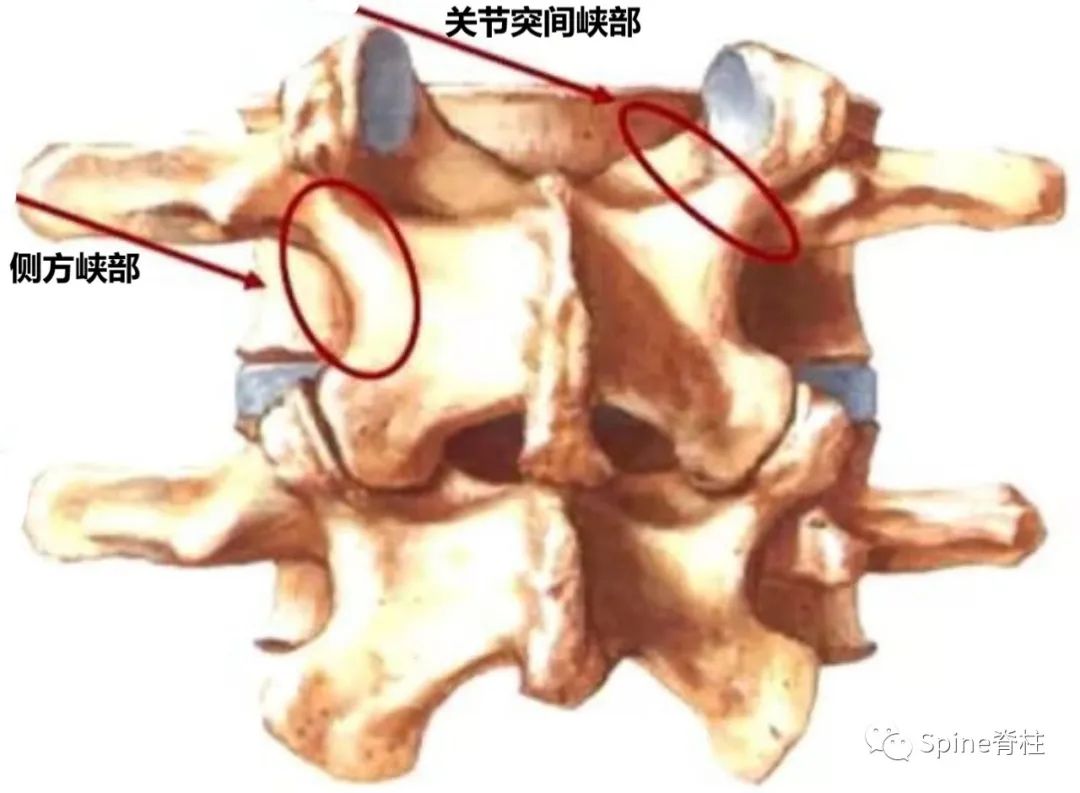 Anatomy of the isthmus and diagnosis and treatment of lumbar ...