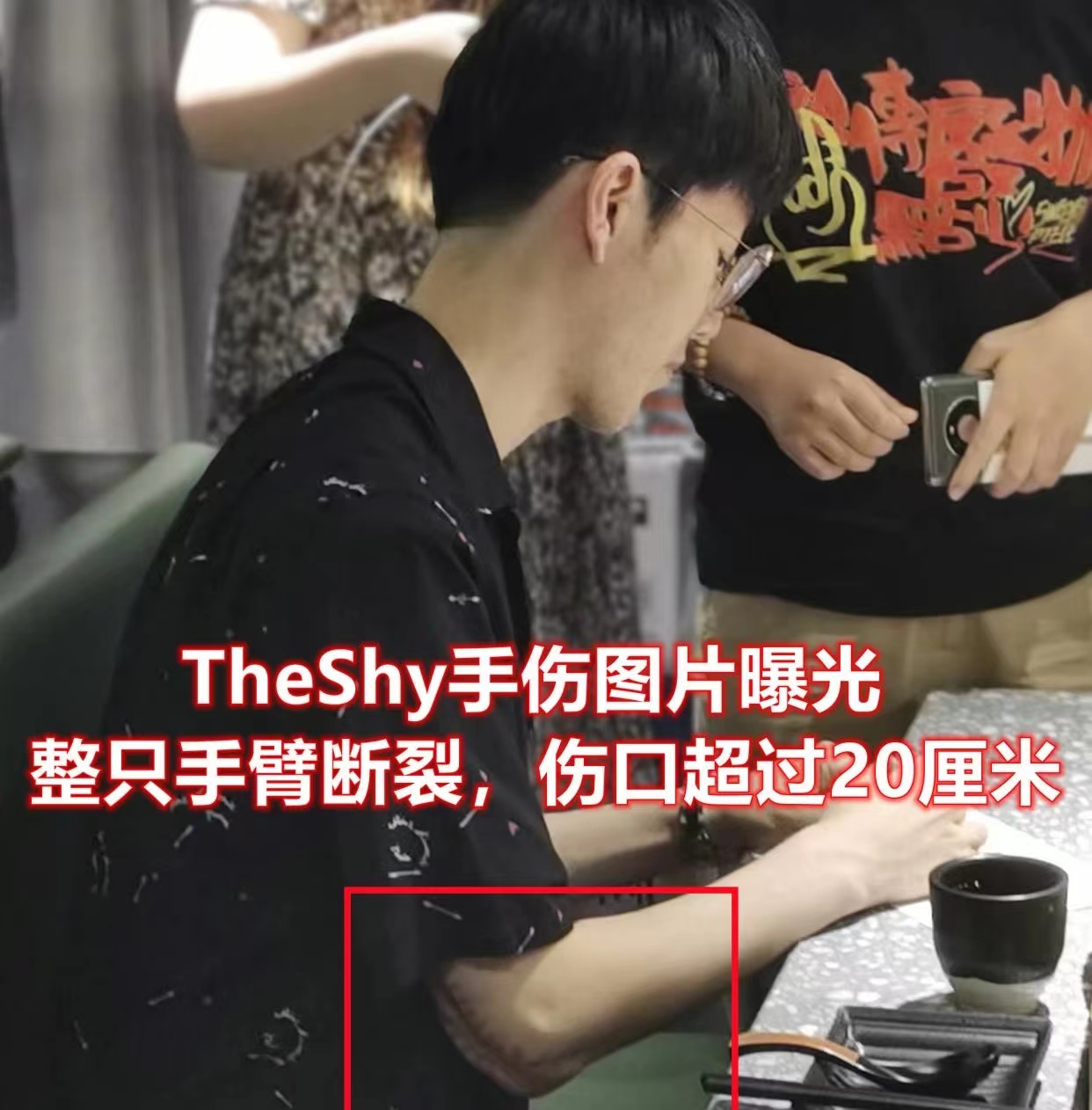 LOL: TheShy underwent eye surgery after a 20cm hand wound, just to get ...