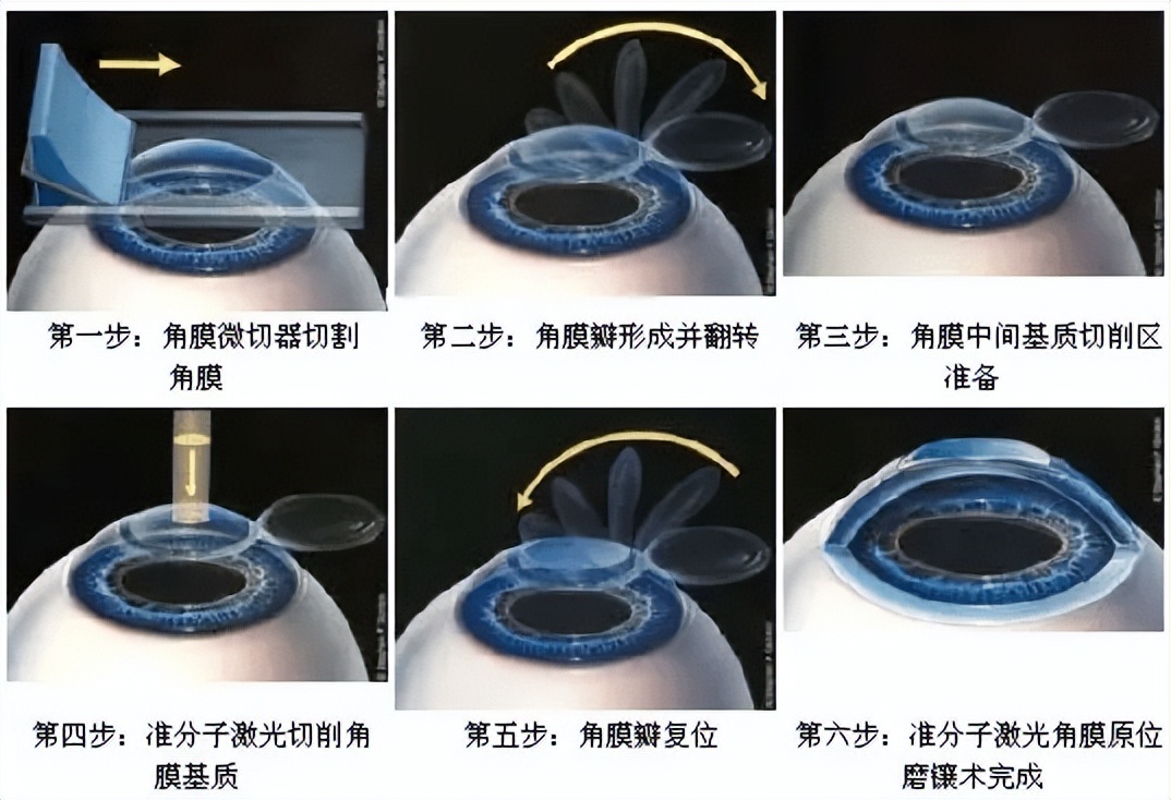 How to choose myopia surgery?Super detailed comparison of the four ...
