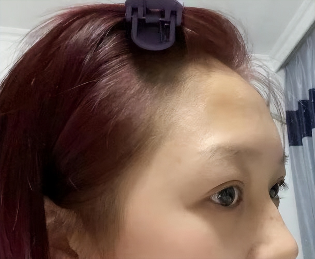 What do the depressions on the forehead mean and how to resolve them ...