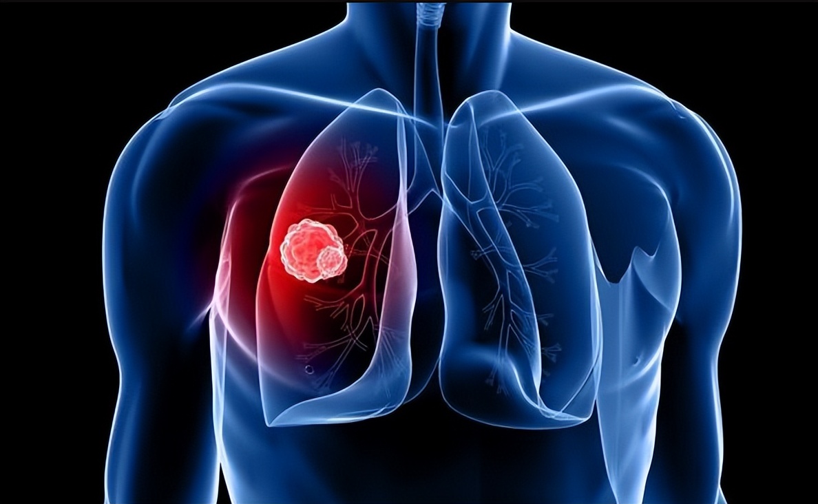 Stage III non-small cell lung cancer achieves a cure, which treatments ...