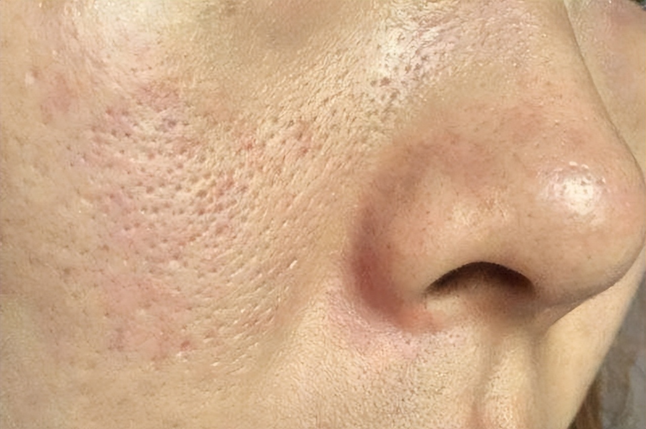How to clean mixed oily skin? Dry, oily, and pimples - iNEWS