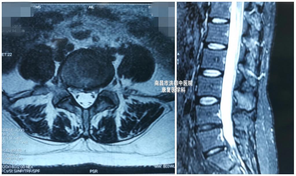 Non-surgical treatment of lumbar disc herniation, learn about it - iMedia