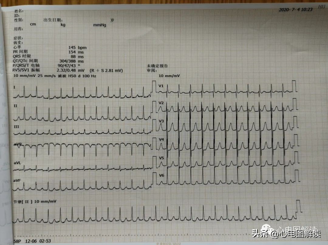 Hard-won "Atrial Flutter" - iNEWS