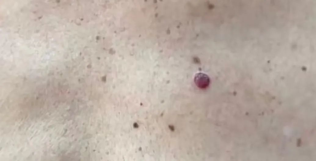 What are the red dots/white dots/black dots on your body? - iNEWS
