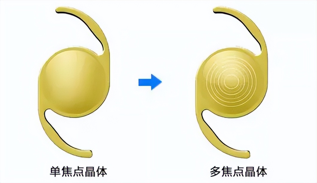 The new type of cataract surgery "Hands-on" - implantation of ...