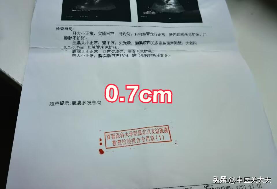 6-year history of gallbladder polyps, Chinese medicine treatment for ...