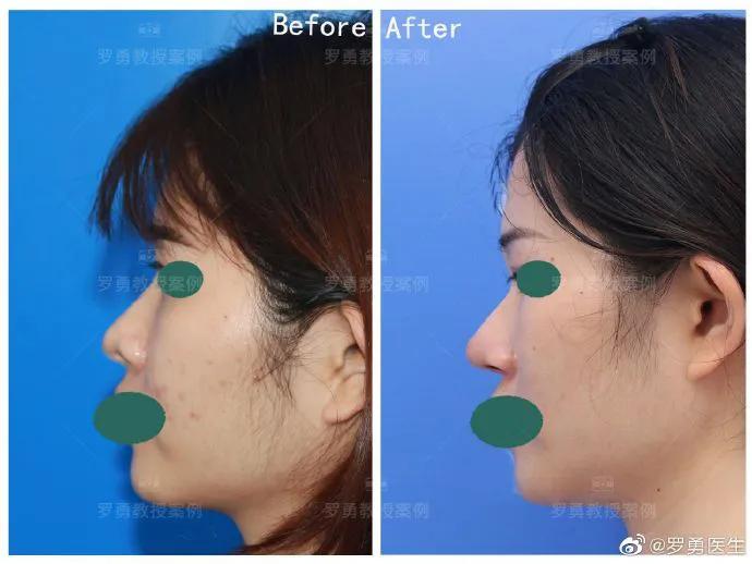 Large nostrils + wide nose wings + collapsed nose bridge - iNEWS