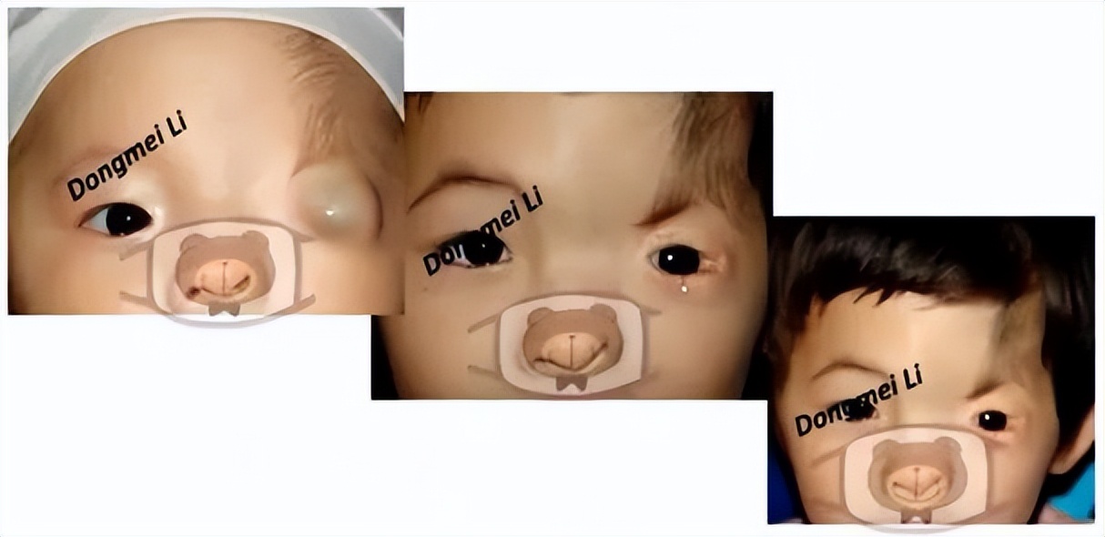 Listen to Professor Li Dongmei's analysis of congenital orbital ...