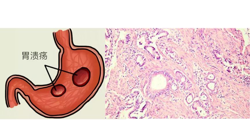 learn a lesson!66-year-old Mr. Zheng suffered from gastric ulcer due to ...