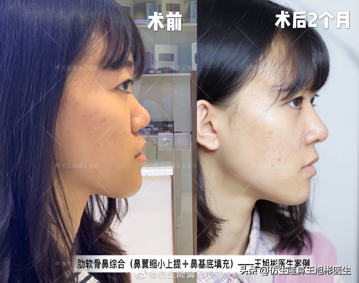 Rhinoplasty: Principles and Cases of Correction of Drooping Nose - iNEWS