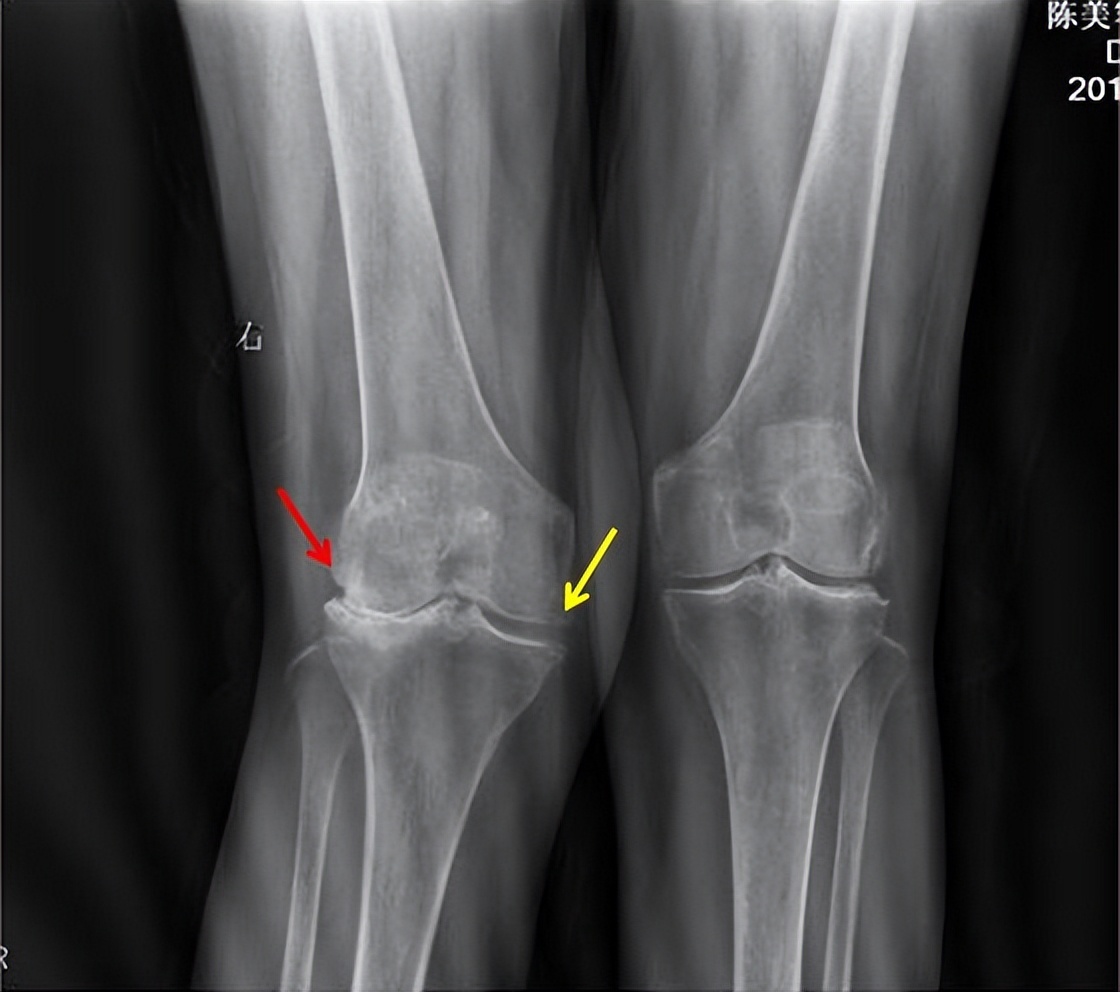 Common Types of Surgery for Total Knee Replacement (2) - Valgus Knee ...