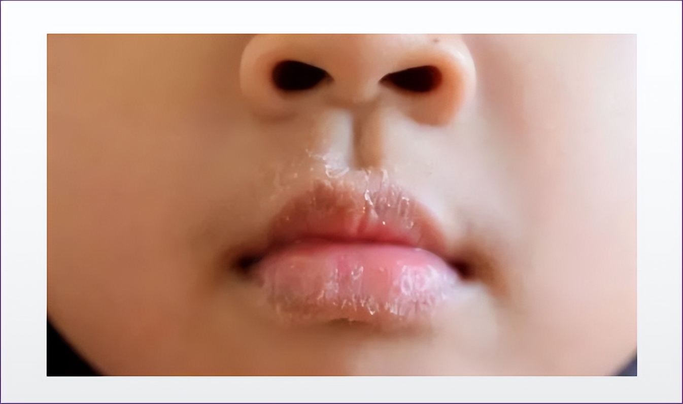 Red cheeks, chapped lips, skin peeling, red ass? - iNEWS