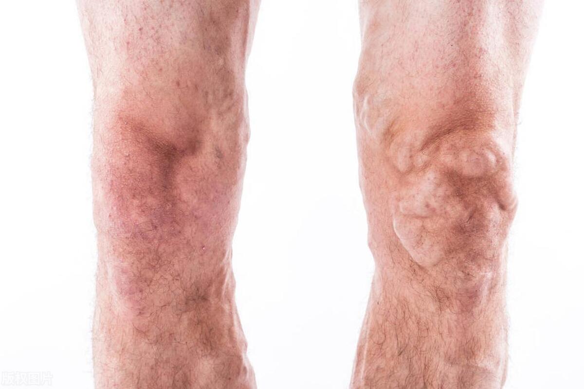 Are Abnormal Legs a Signal of Cancer? Doctor: These 3 abnormalities ...