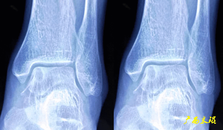 Diagnosis and treatment of talus osteochondral injury - iNEWS