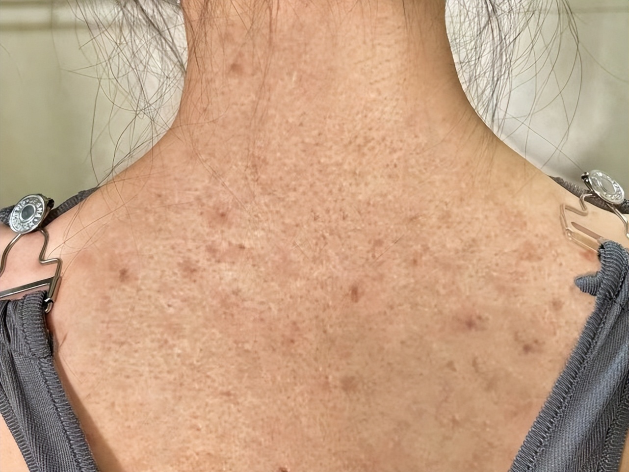 Rub away mites in 5 seconds! Acne on the back can be removed with one ...