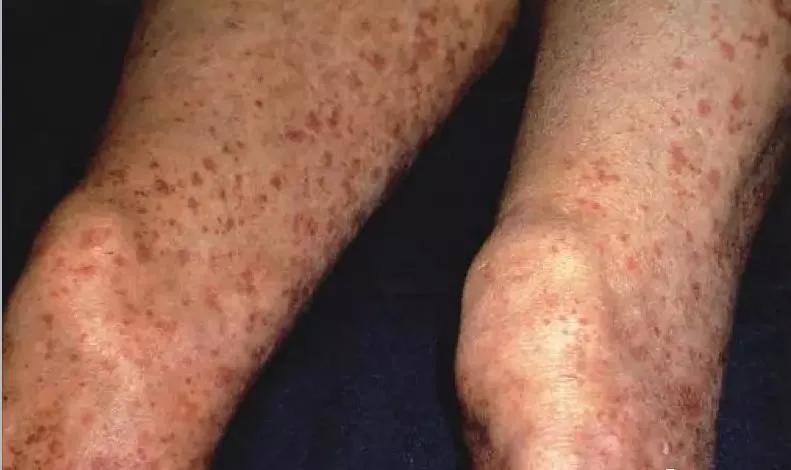 Why do purple spots appear on the body? - iNEWS