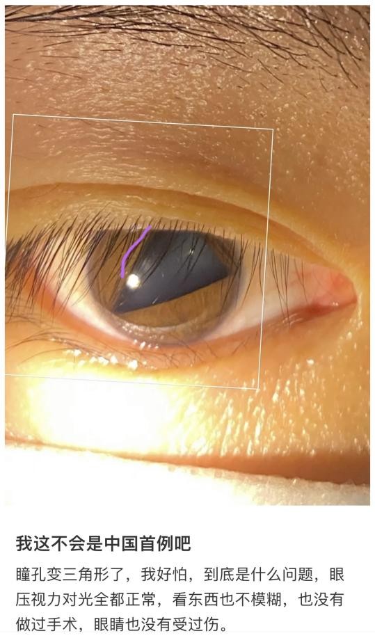 The pupil suddenly turned into a triangle, which turned out to be a ...