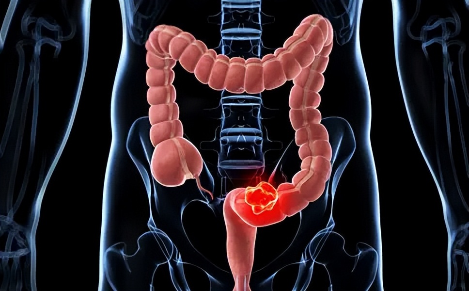 Blood in the stool, abdominal pain, developed into rectal cancer two ...