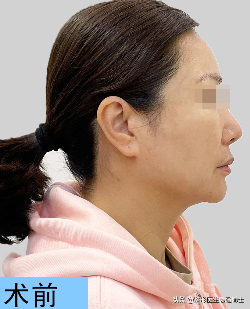 At 47 years old, I had a small temporal facelift + facetite. I was ...
