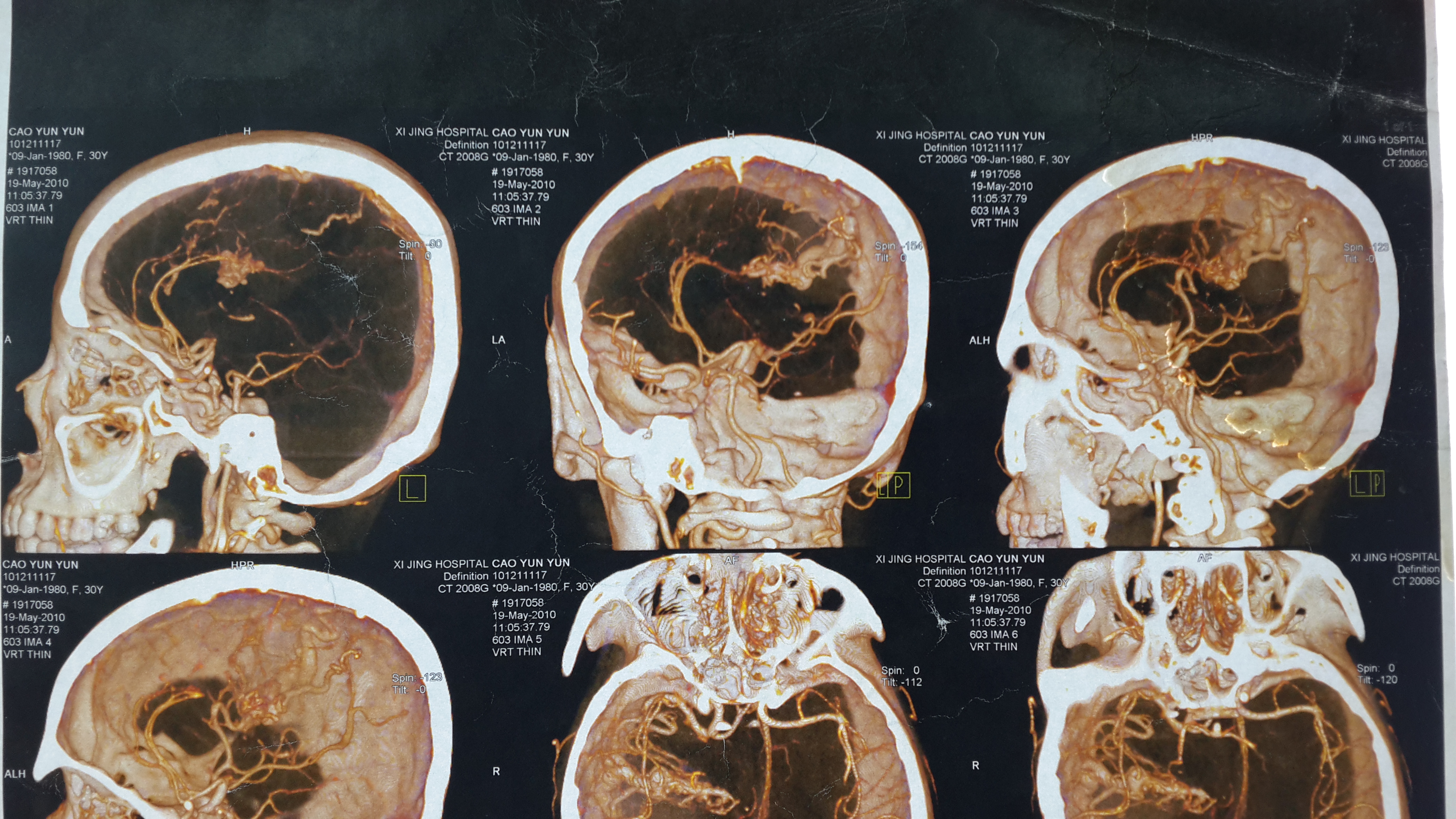 Replay of Prof. He Xiaosheng's Classic Surgery—Craniotomy for Brain ...