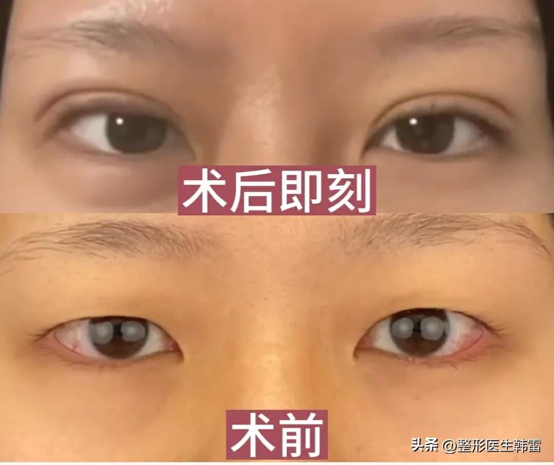 How long does it take for thread-buried double eyelids to return to ...