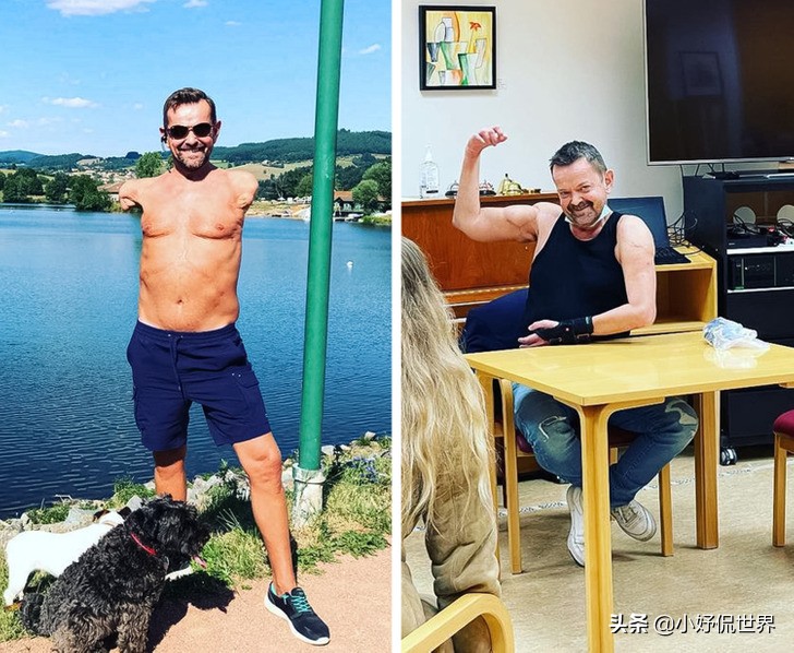 Medical miracle: Man with arm and shoulder amputated is finally able to ...