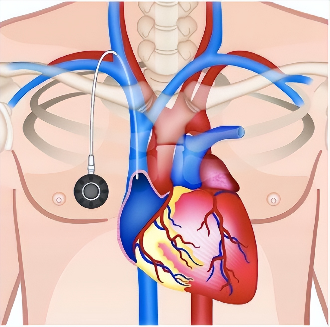 Is it safe for cancer patients to be placed in the infusion port?What ...