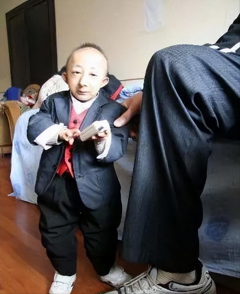 He Pingping: He became "the world's first dwarf" at the age of 19, died ...