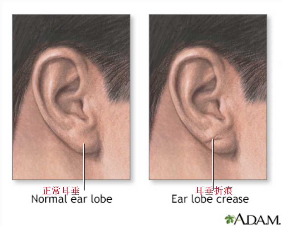 What is earlobe crease?What is the relationship between earlobe folds ...