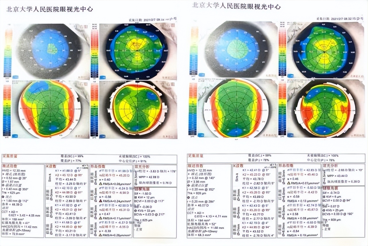 Prof. Peng Zisu's analysis: the causes of long-term monocular high ...