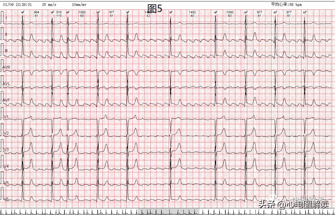 Atrial flutter - iNEWS