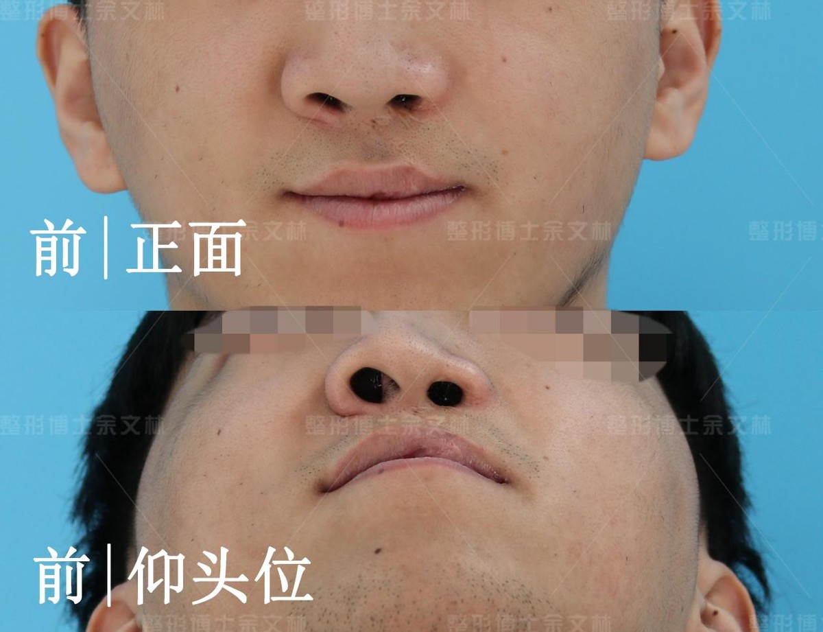 Can a nose with a cleft lip (palate) be perfected? - iNEWS