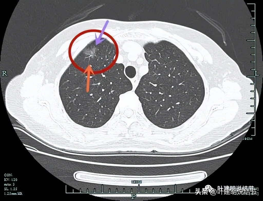 Such a typical ground glass nodule with invasive features (spiky sign ...