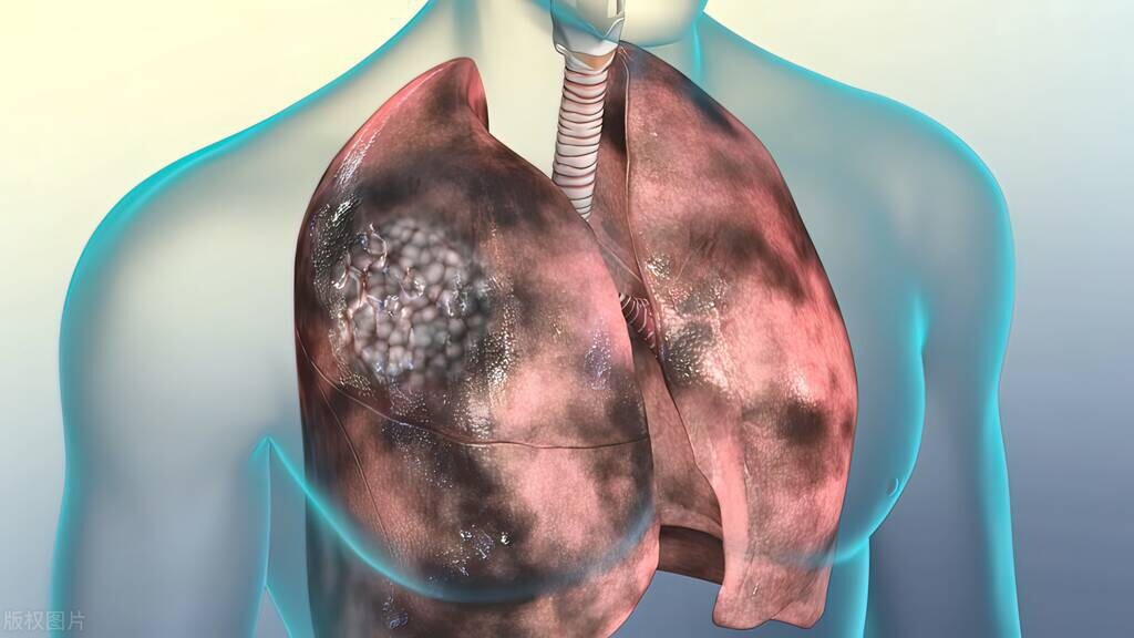 Poor lungs, asthma when walking? Listen to the doctor tell the truth ...