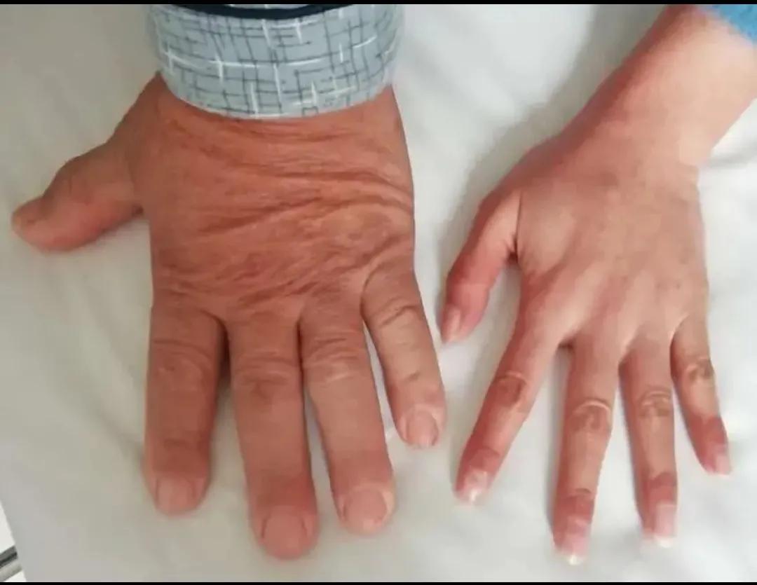 Illustrated to understand what is acromegaly? - iNEWS