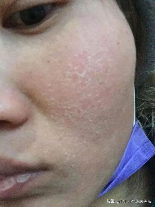 Winter is here, how to get rid of dead skin on the face? - iNEWS